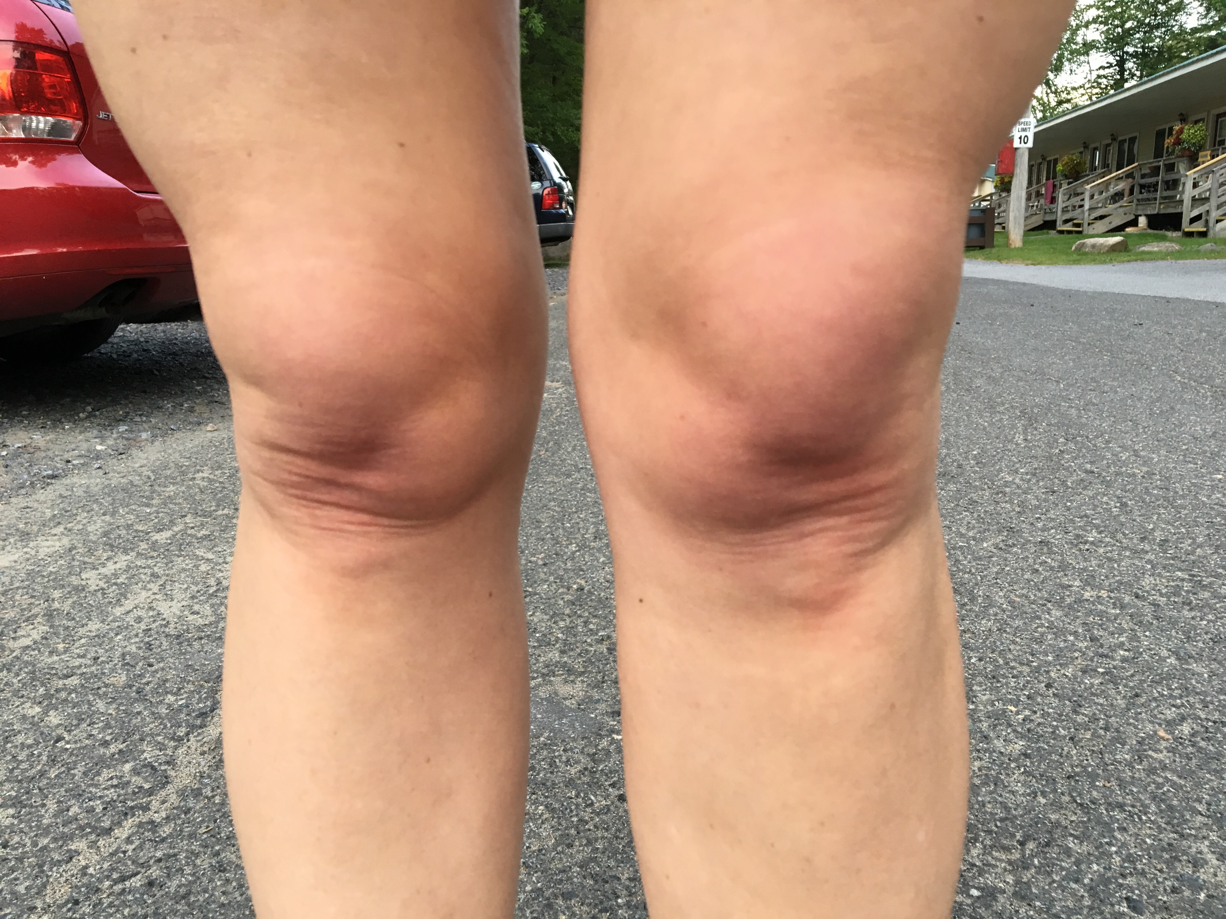 Fluid Retention Joint Hypermobility And My Knees Strength